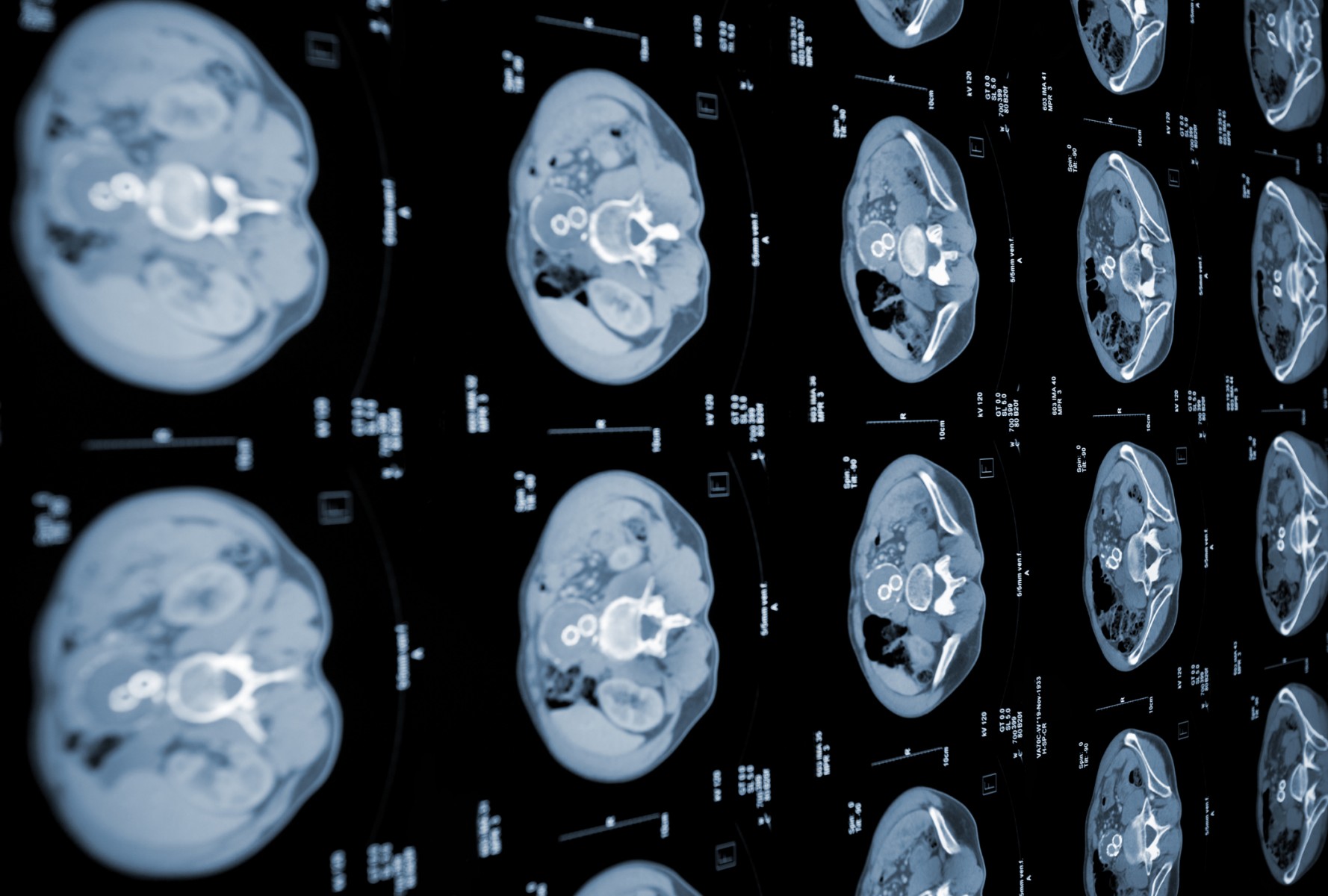 Artificial Intelligence Shows Potential for Diagnosing Pancreatic ...